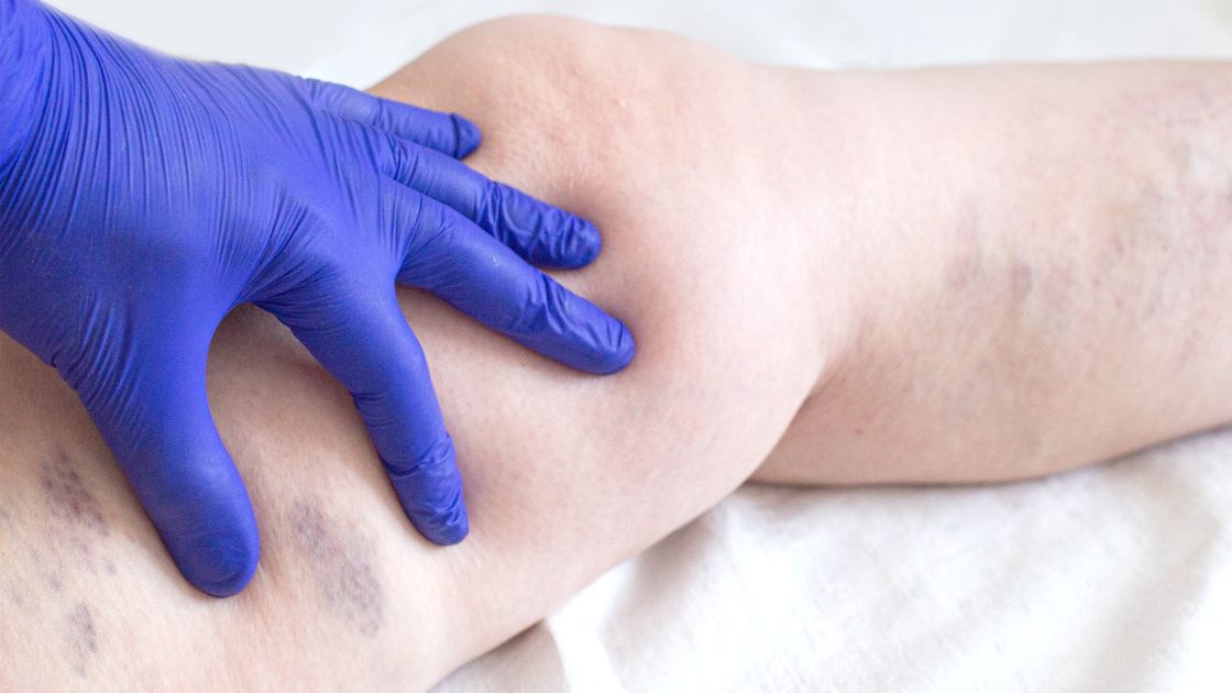 At Home Massage: Rolling Pin for Self-Massage| Moyer Total Wellness